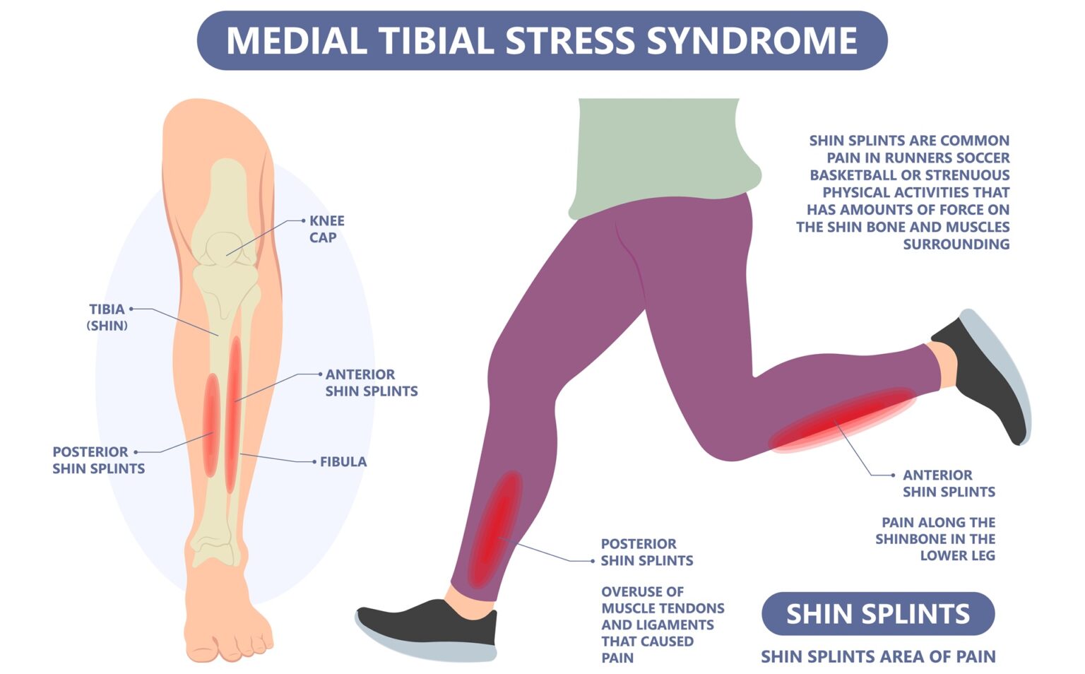 Medial Tibial Stress Syndrome/Shin Splints – Taylors Lakes Podiatry Clinic